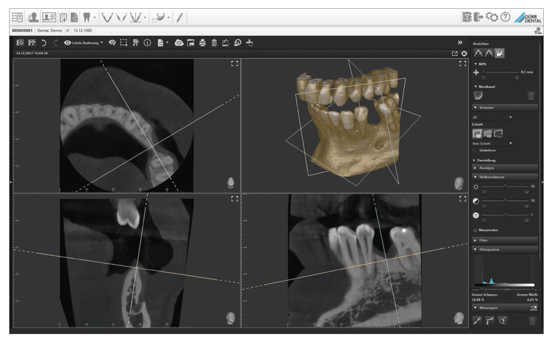 Logiciel 3D VistaSoft Dürr Dental : un flux de travail simple et ...
